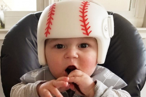 Cranial Helmets and Your Baby’s Skin | Cranial Therapy Centers