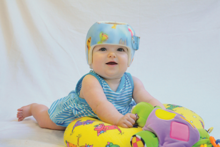 Cranial Helmets and Your Baby’s Skin | Cranial Therapy Centers