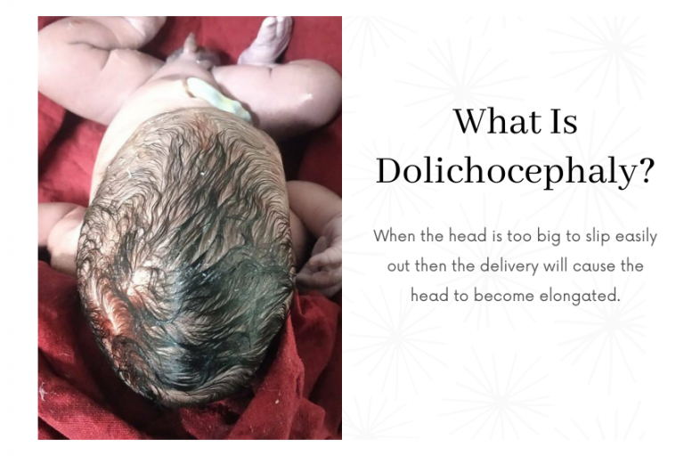 What Can Be Done When an Infant Has An Elongated Head? | Cranial ...